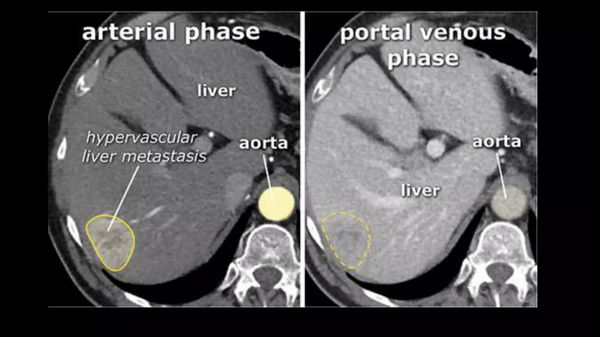 Liver segments Radiopaedia.com1