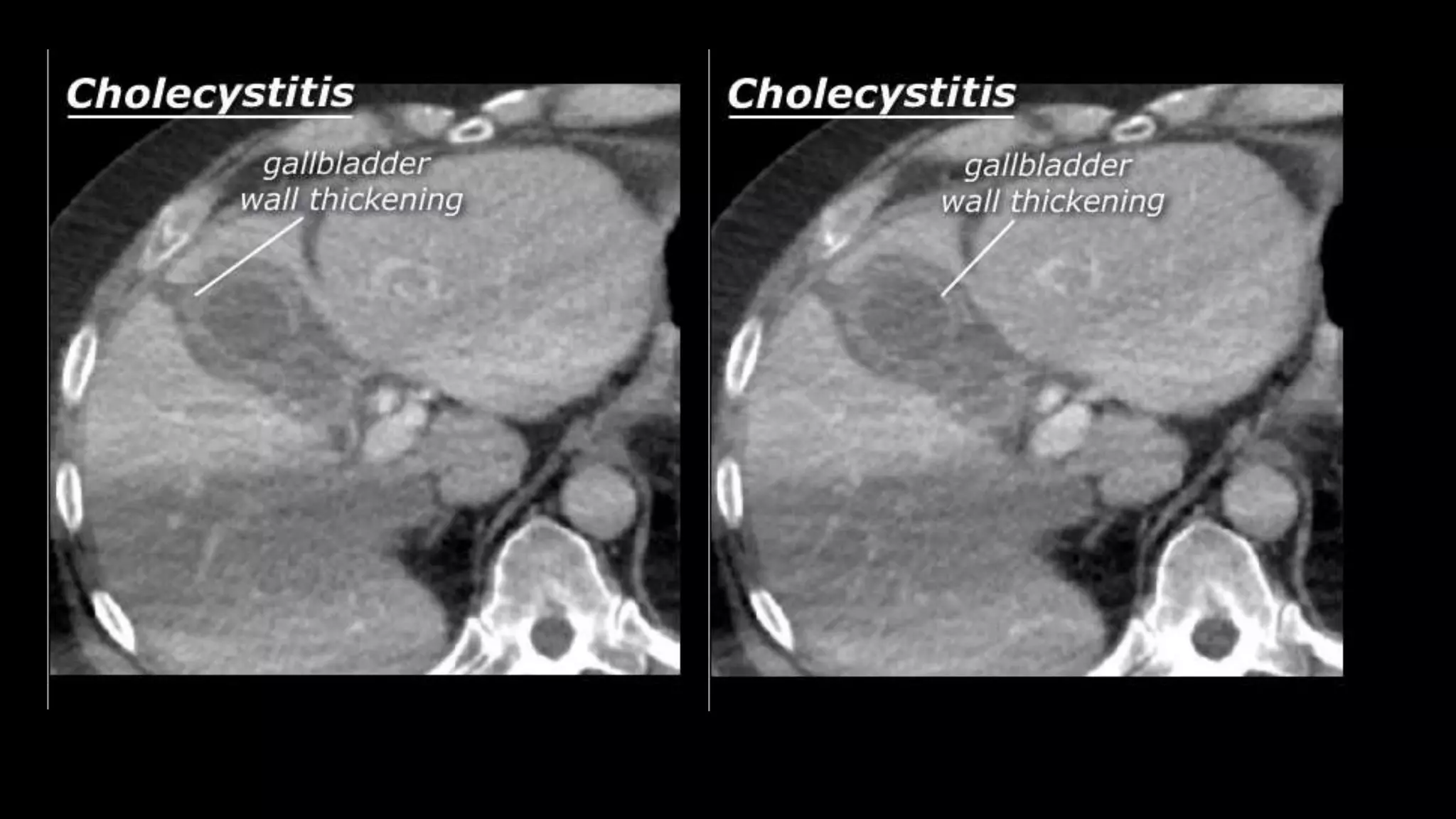 Liver segments Radiopaedia.com1