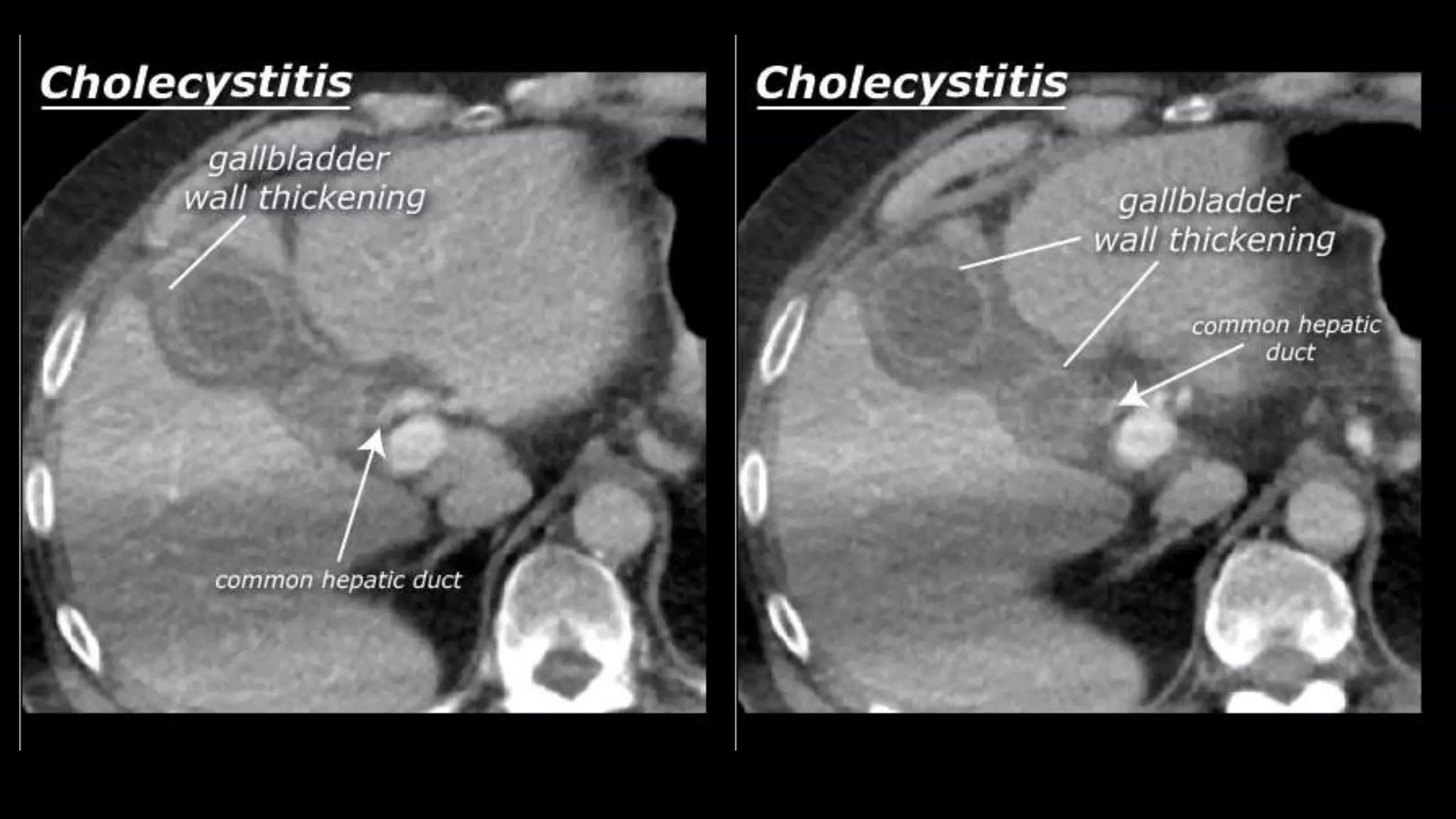 Liver segments Radiopaedia.com1