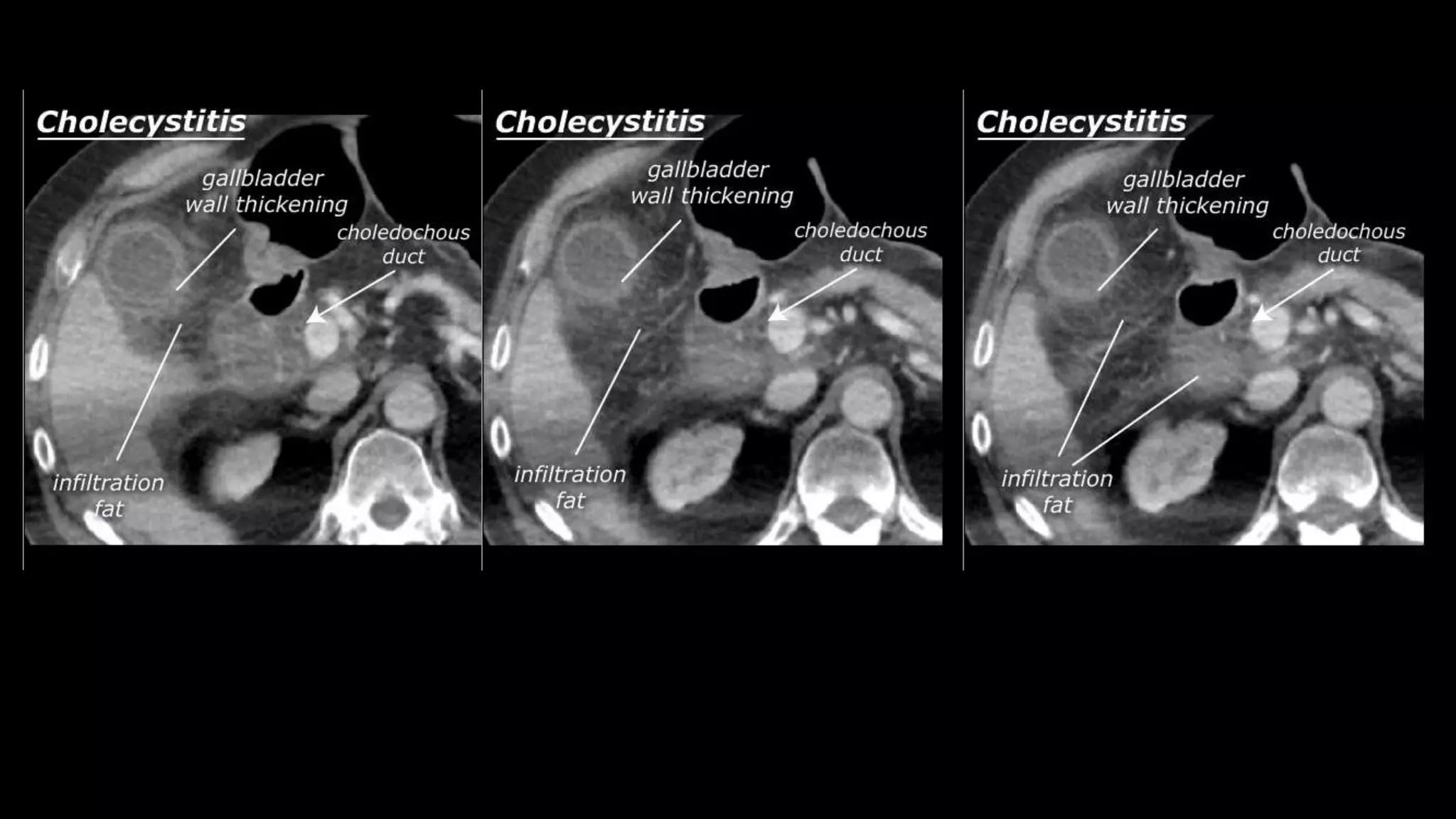 Liver segments Radiopaedia.com1