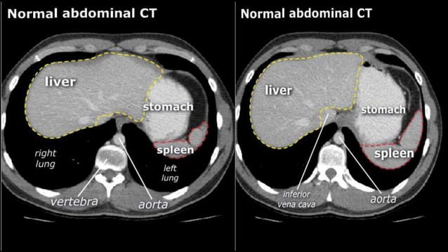 Liver segments Radiopaedia.com1