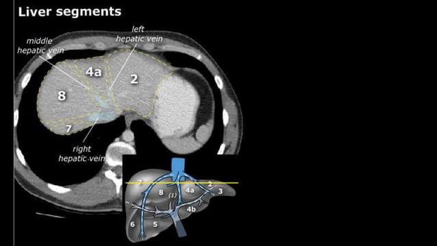 Liver segments Radiopaedia.com1