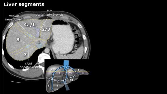 Liver segments Radiopaedia.com1