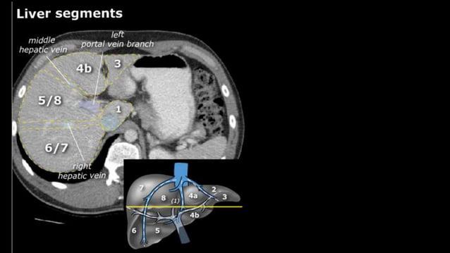 Liver segments Radiopaedia.com1