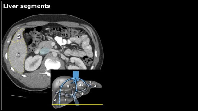 Liver segments Radiopaedia.com1