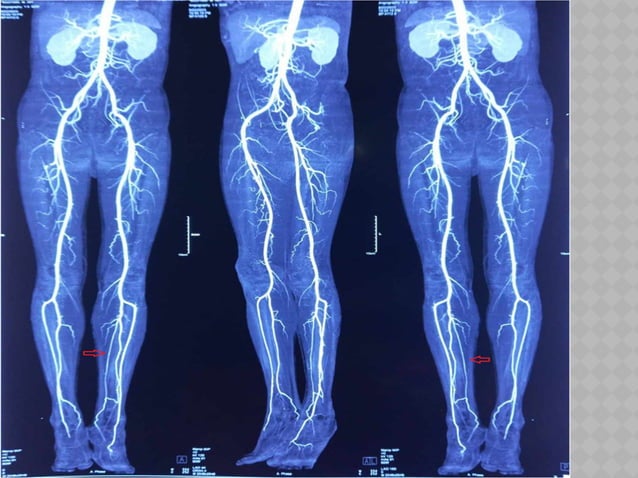 CT Lower Limb Angiography: Techniques, Indications, Protocols, Image ...