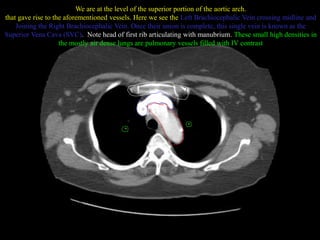 ct anantomy lung for rt planning | PPTX
