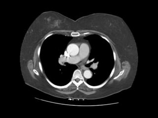 ct anantomy lung for rt planning | PPT | Free download