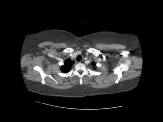 ct anantomy lung for rt planning | PPT | Free Download