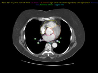 ct anantomy lung for rt planning | PPT