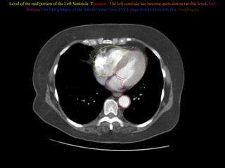 ct anantomy lung for rt planning | PPTX
