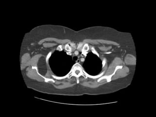 ct anantomy lung for rt planning | PPT | Free Download