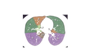CT LUNG BRONCHO PULMONARY SEGMENTS ANATOMY.pptx