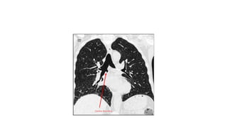 CT LUNG BRONCHO PULMONARY SEGMENTS ANATOMY.pptx