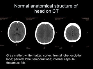 Ct & mri of central nervous system | PPT