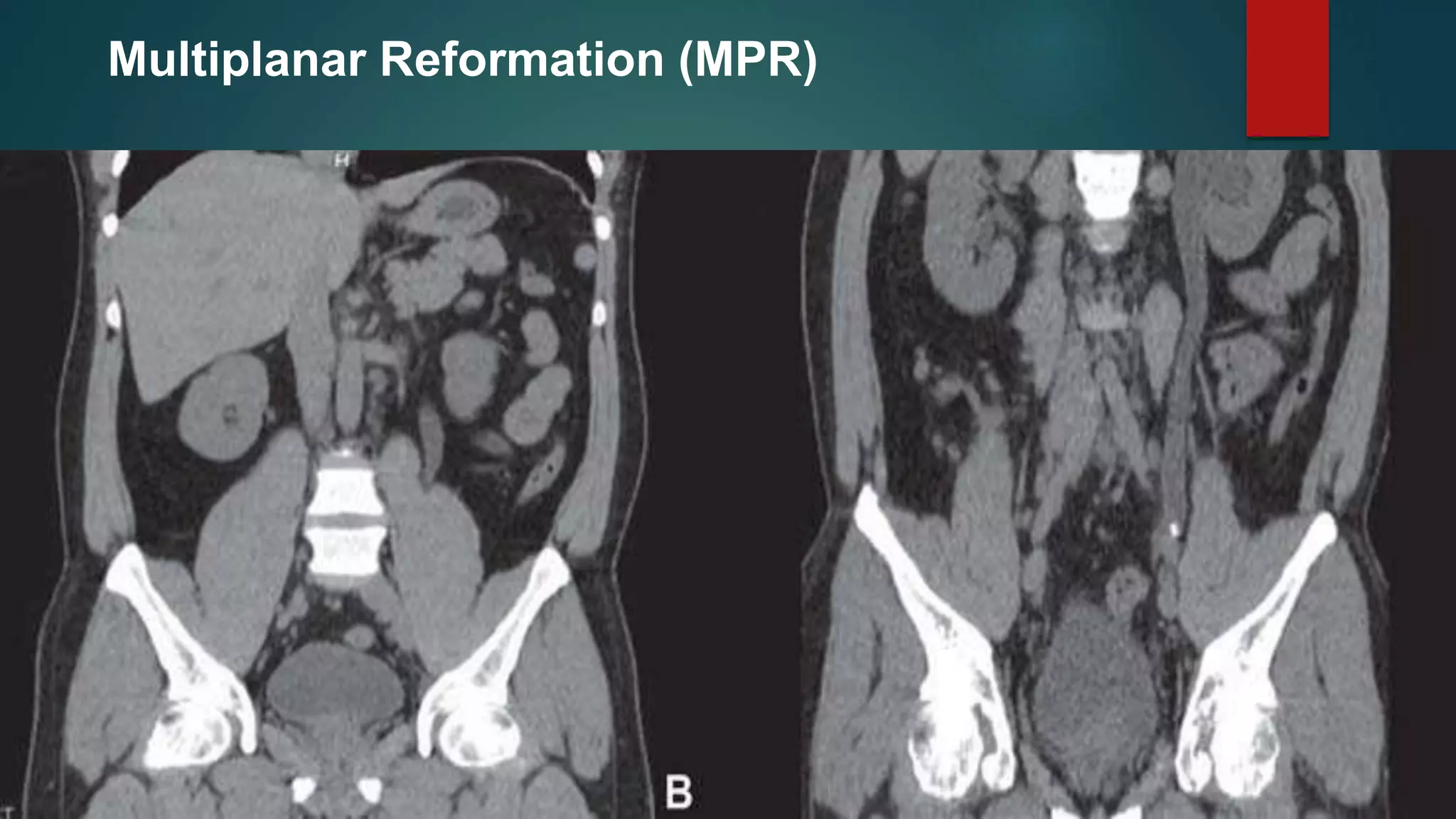 Ct mri urography | PPTX