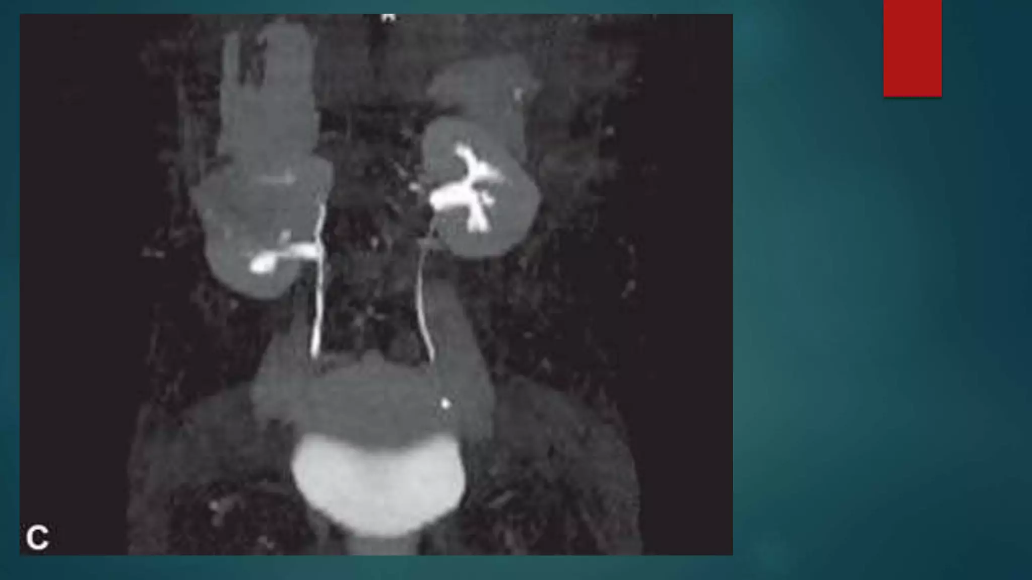 Ct mri urography | PPTX