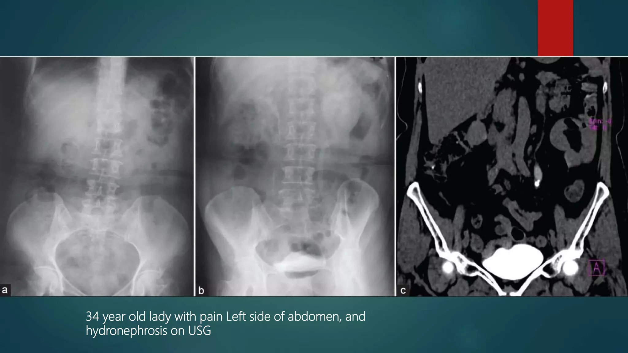 Ct mri urography | PPTX