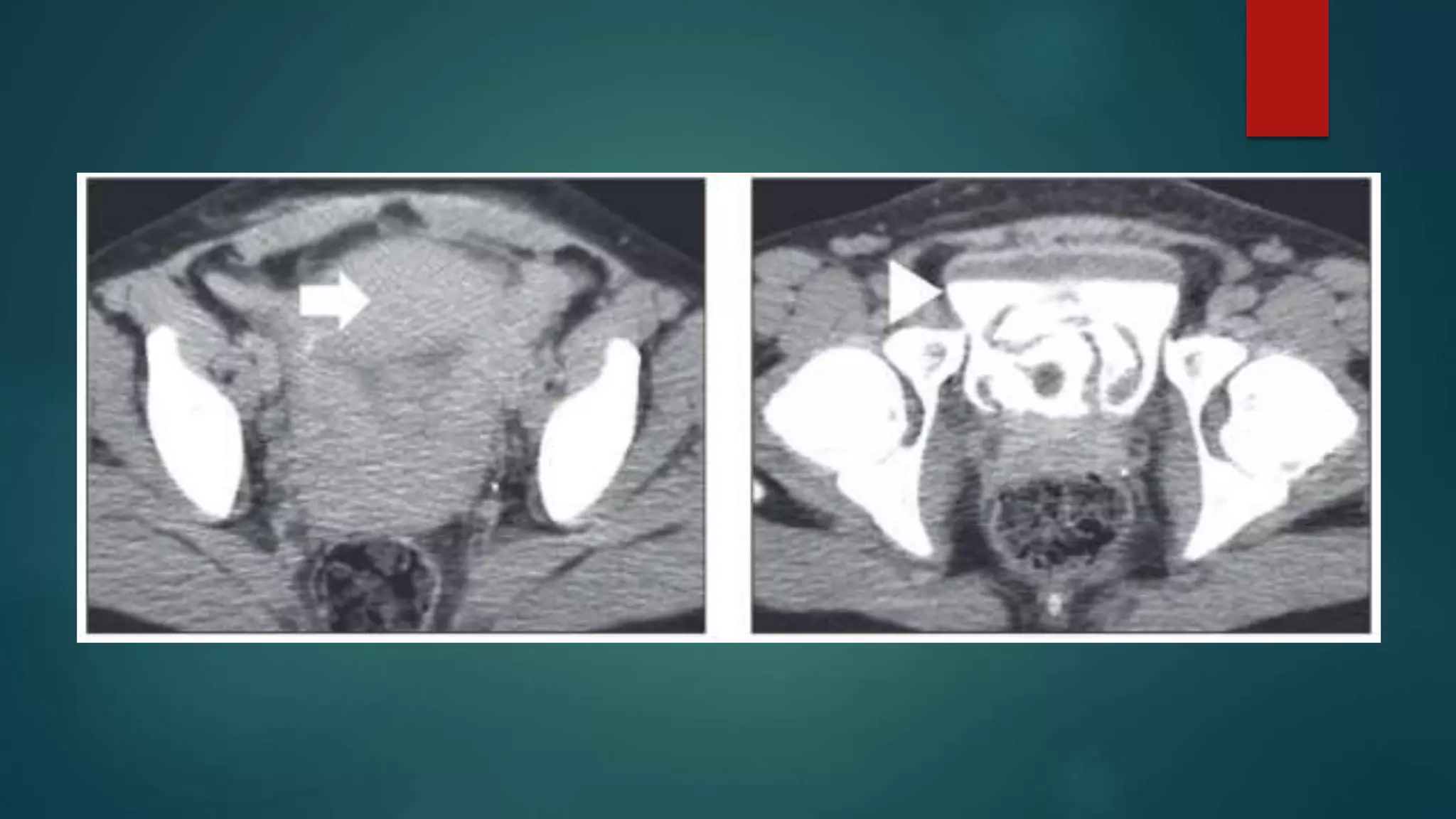 Ct mri urography | PPTX