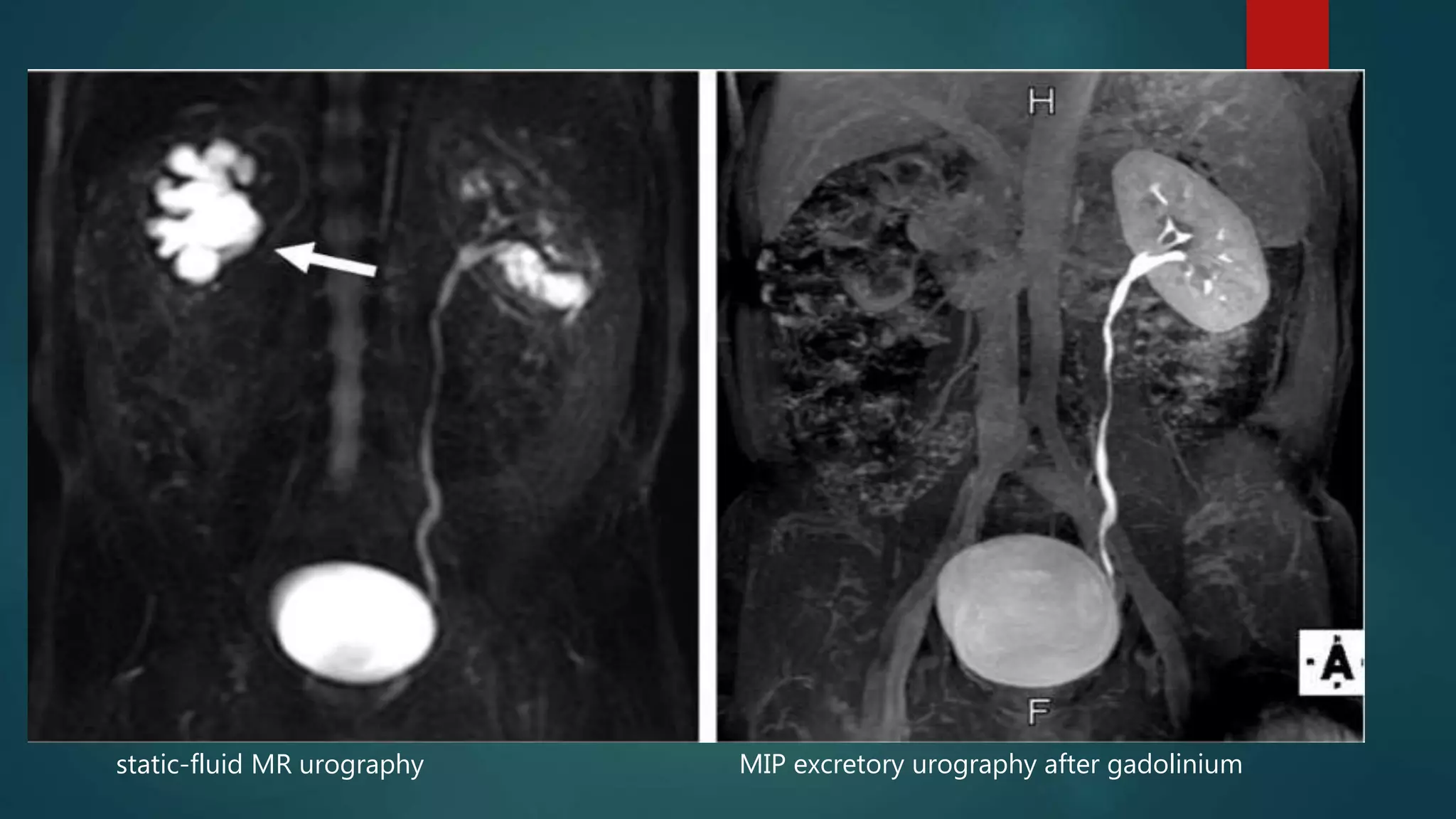 Ct mri urography | PPTX | Medical Tests | Medical Health