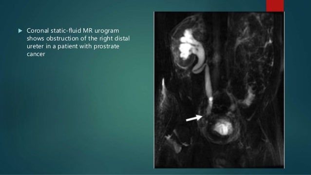 Ct mri urography