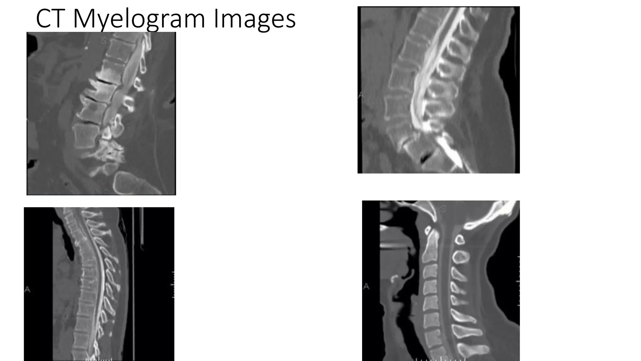 CT Myelography | PPTX