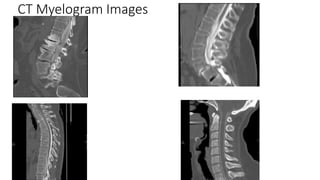 CT Myelography | PPTX
