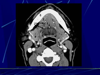 CT ANATOMY OF THE NECK SPACES | PPT