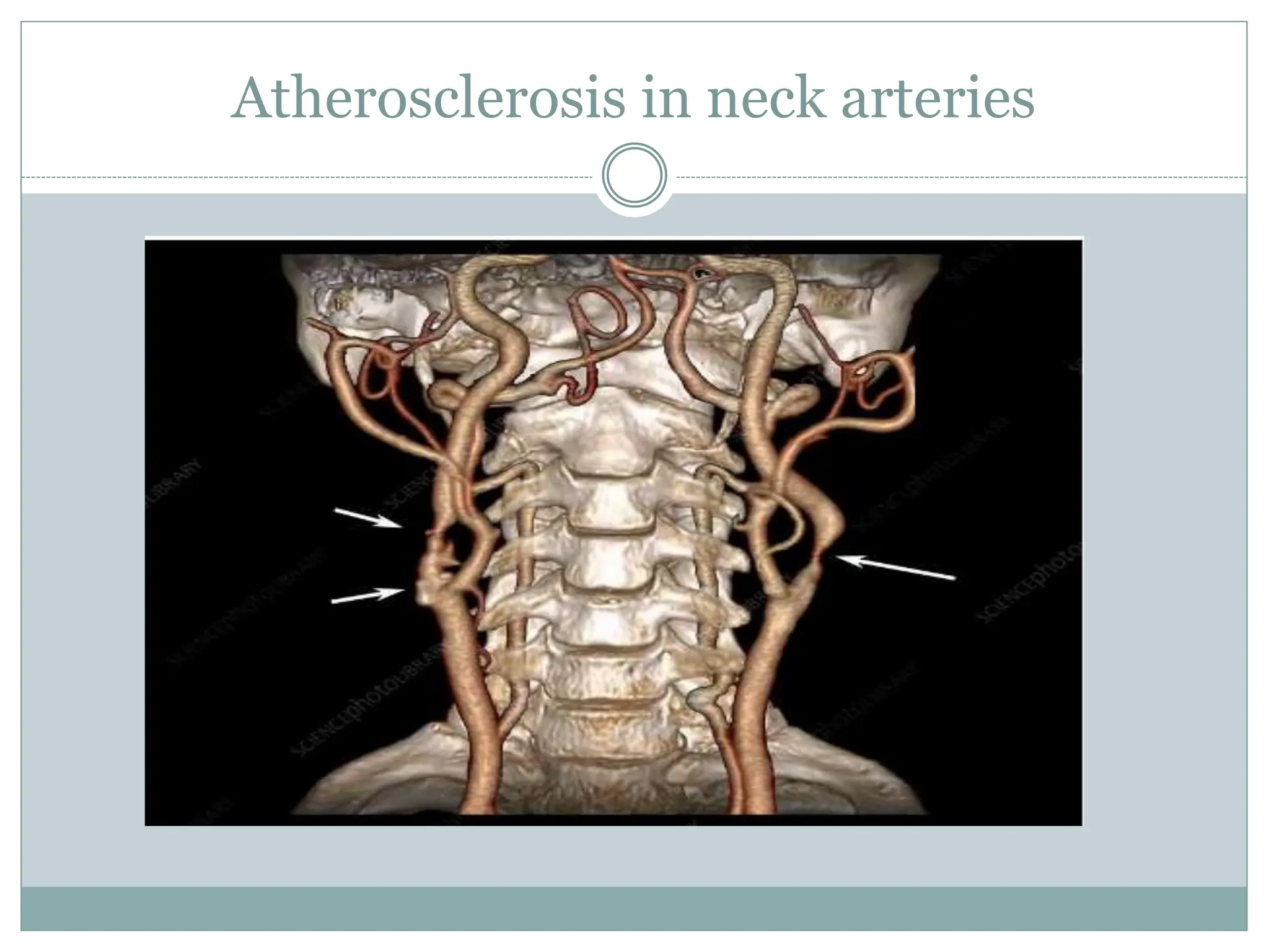 CT Neck angiography.pptx,nodal disease. Tumor, lymphoma and metastases ...