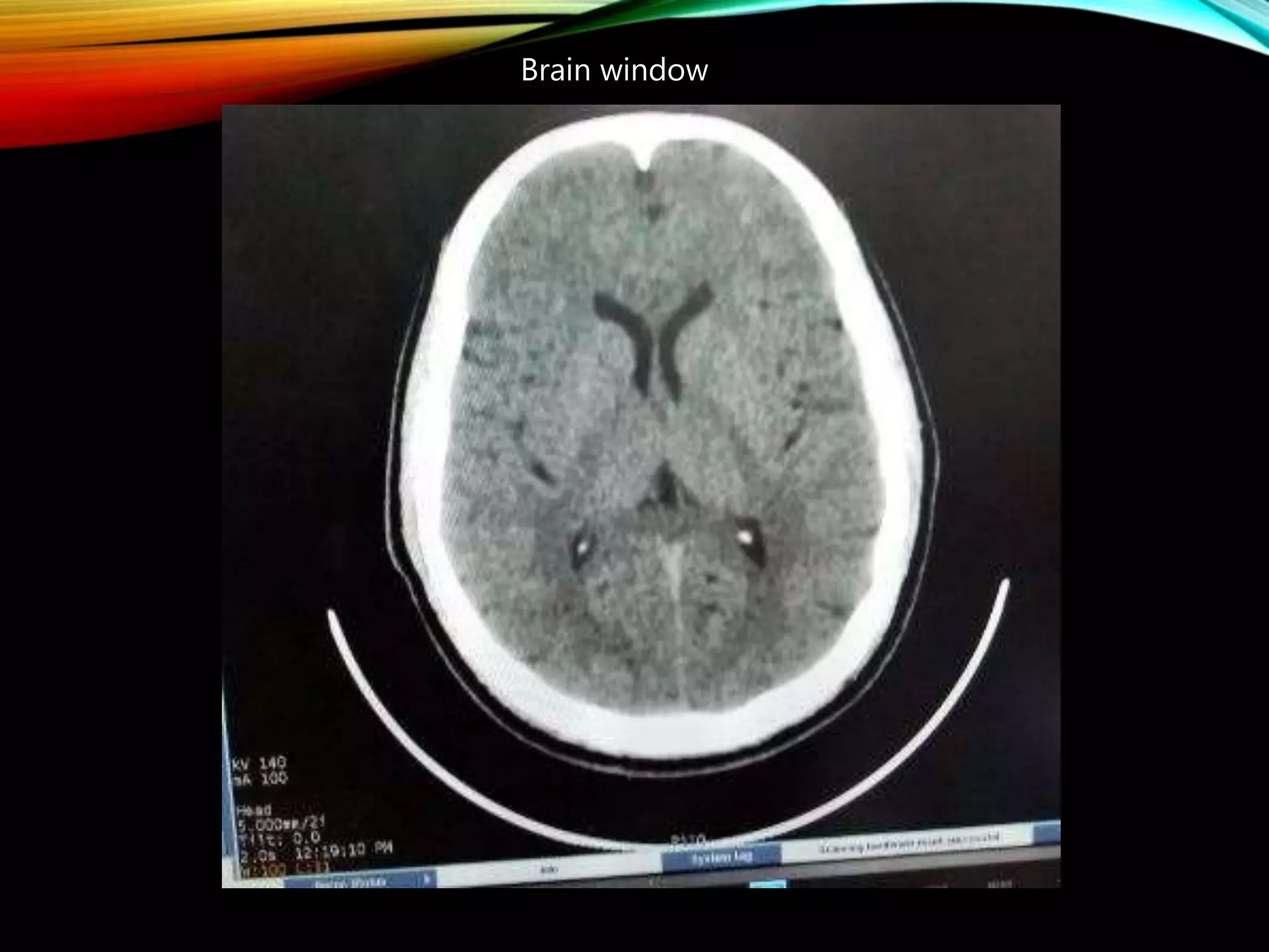 CT numbers, window width and window level | PPTX