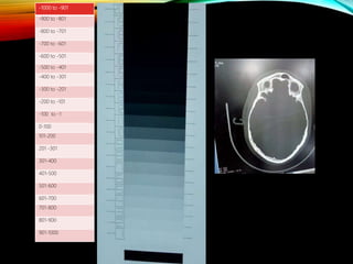 CT numbers, window width and window level | PPTX