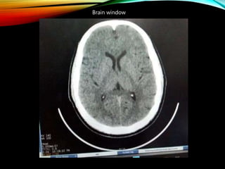 CT numbers, window width and window level | PPTX