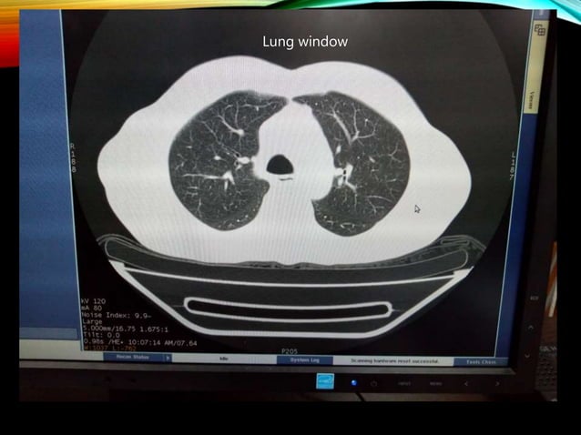 CT numbers, window width and window level | PPTX | Lung and Respiratory ...