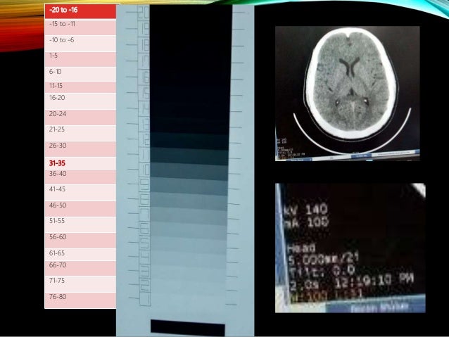 CT numbers, window width and window level
