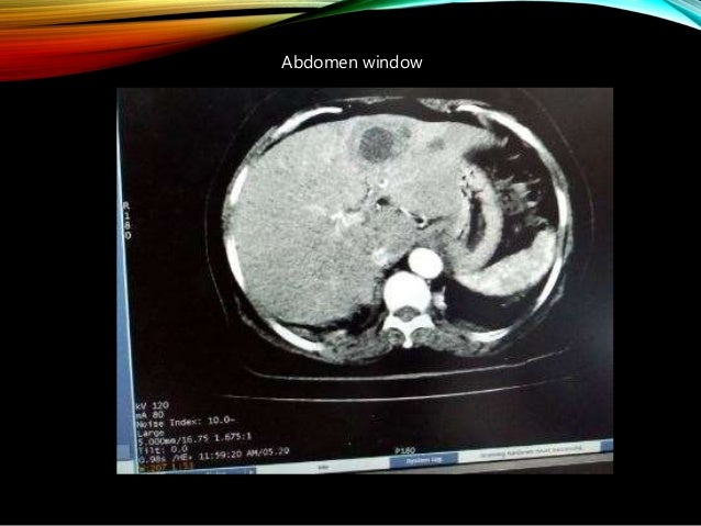 CT numbers, window width and window level