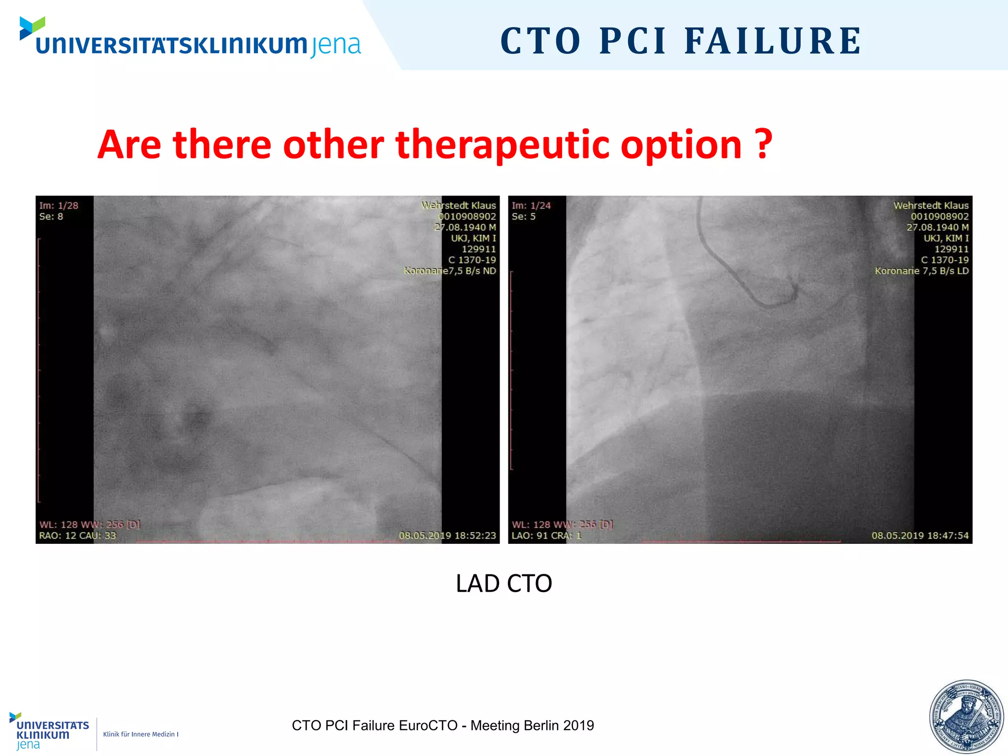 CTO PCI failure – When to try again? | PPT