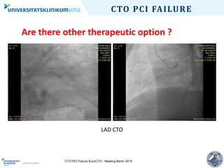 CTO PCI failure – When to try again? | PPT