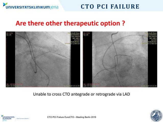 CTO PCI failure – When to try again? | PPT