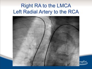 Alaswad K 2016 CTO PCI via radial approach | PPT