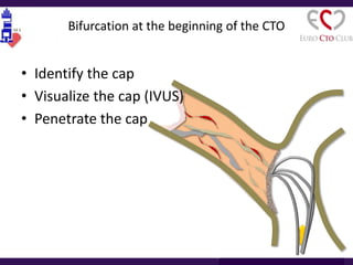 CTO and bifurcation: Tips and tricks | PPTX