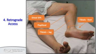 Treatment of Long Lesions and Femoropopliteal CTO | PPSX
