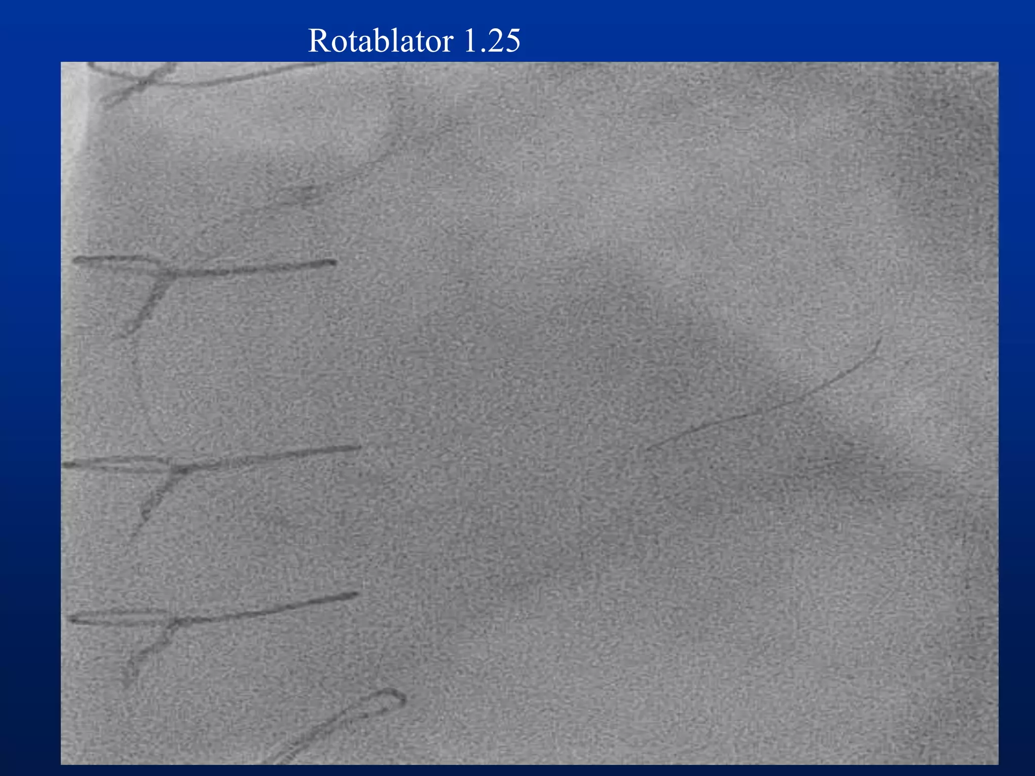 Rotablator and CTO (Rotablator‘s birthday: 30 years old in 2018) | PPT ...