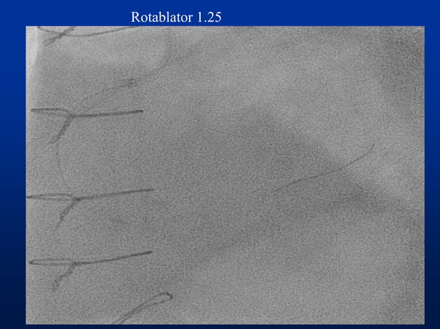Rotablator and CTO (Rotablator‘s birthday: 30 years old in 2018) | PPT ...