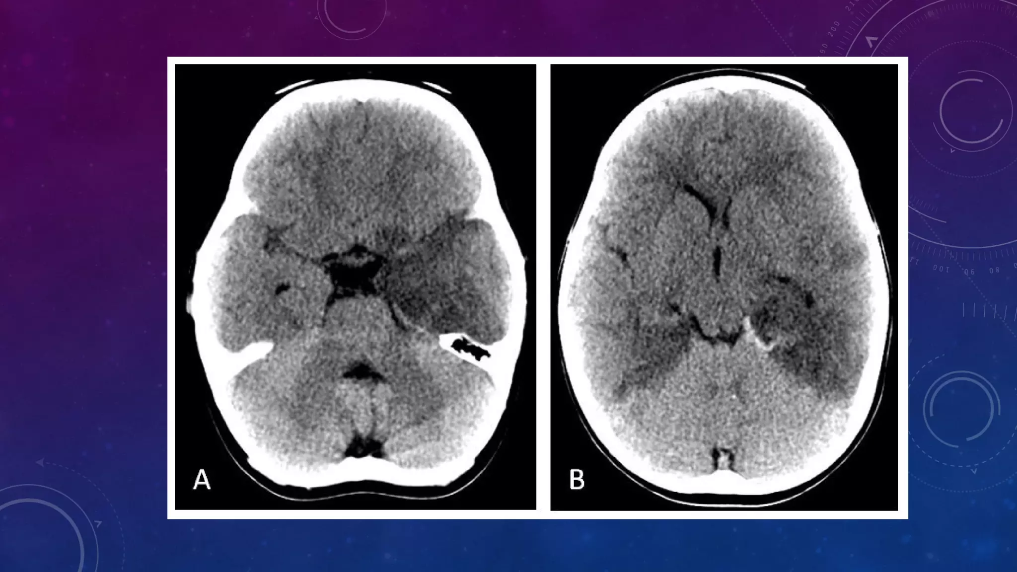 Ct of cns infections 28-8 - 2003 | PPT