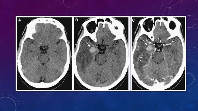 Ct of cns infections 28-8 - 2003 | PPT