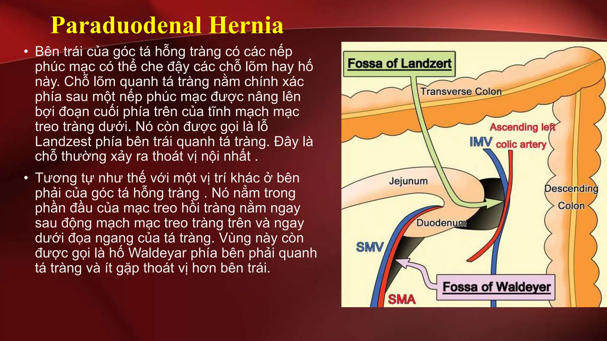 CT of Internal Hernia | PPTX