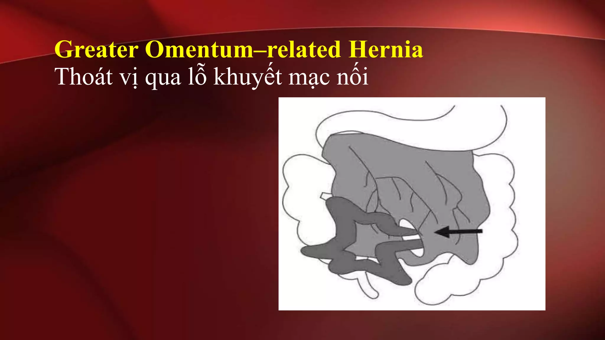 CT of Internal Hernia | PPTX