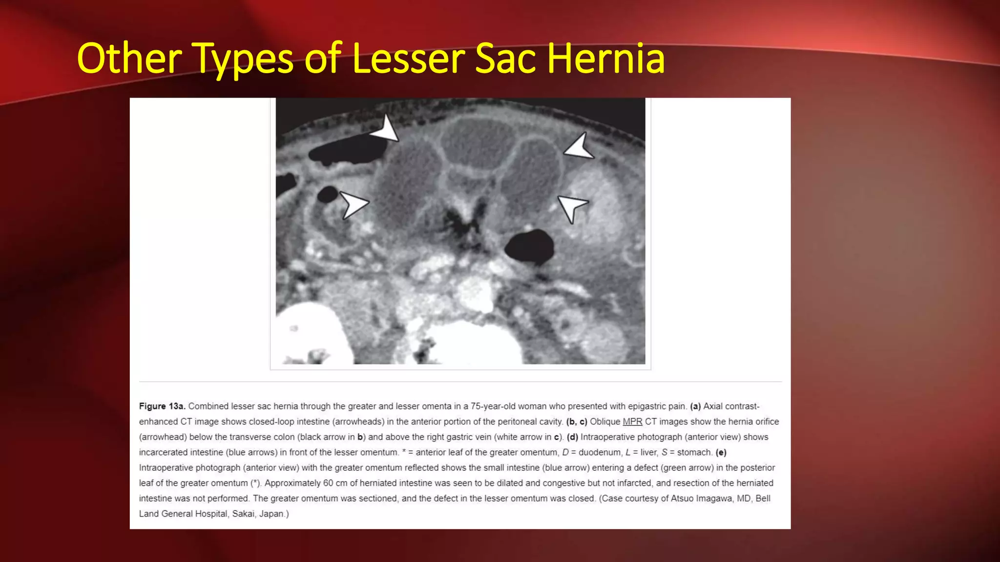 CT of Internal Hernia | PPTX