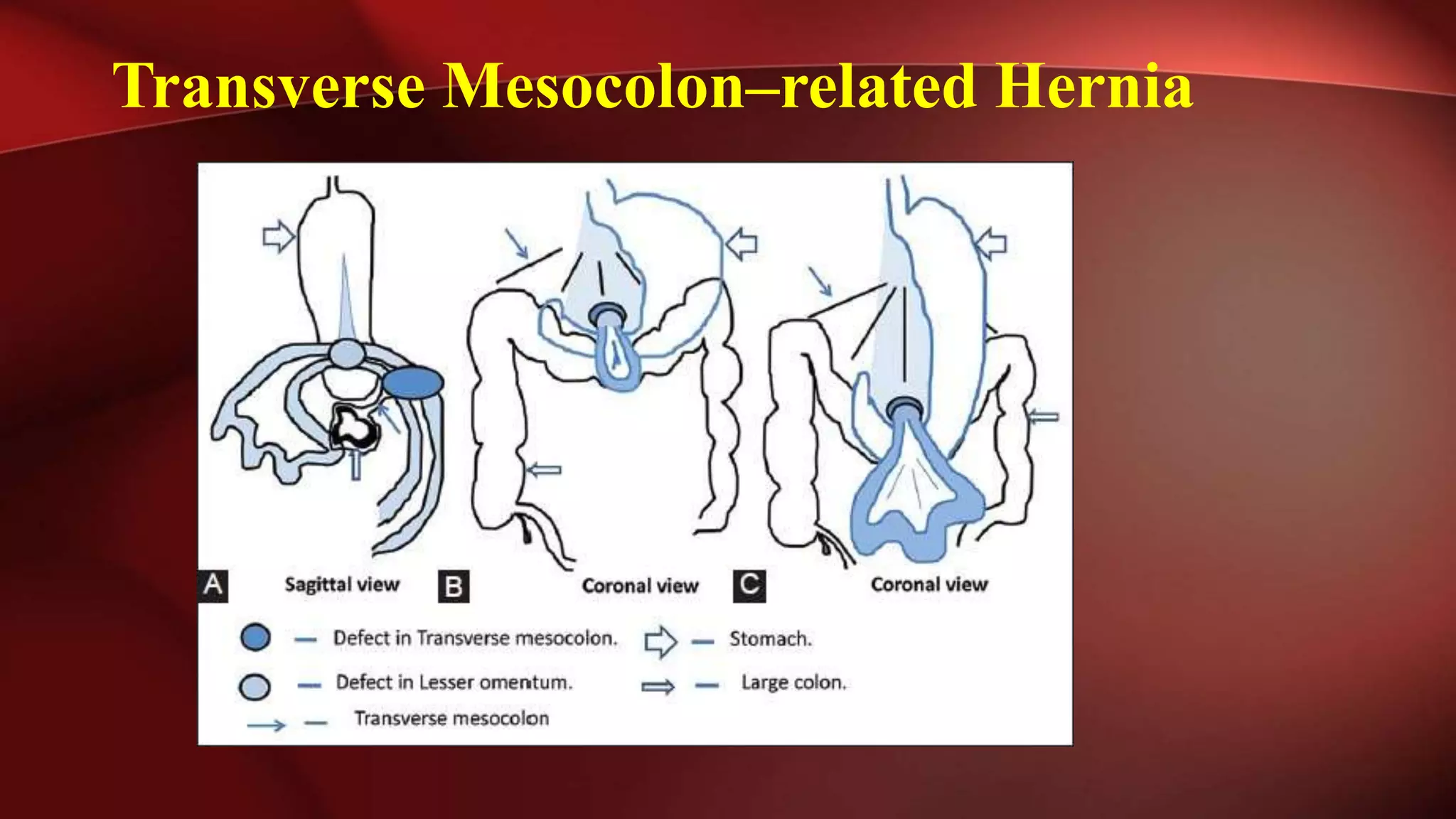 CT of Internal Hernia | PPTX