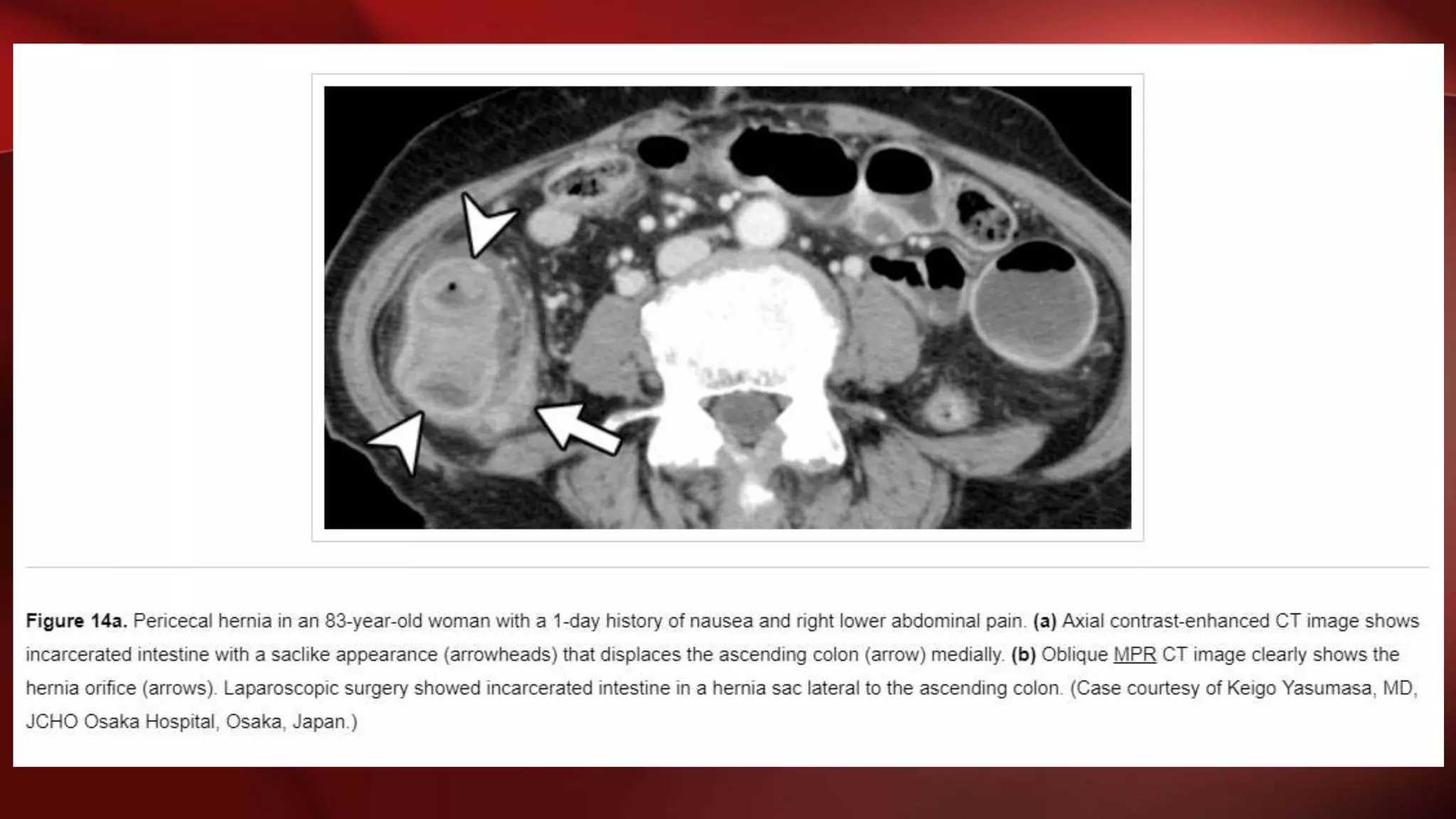CT of Internal Hernia | PPTX